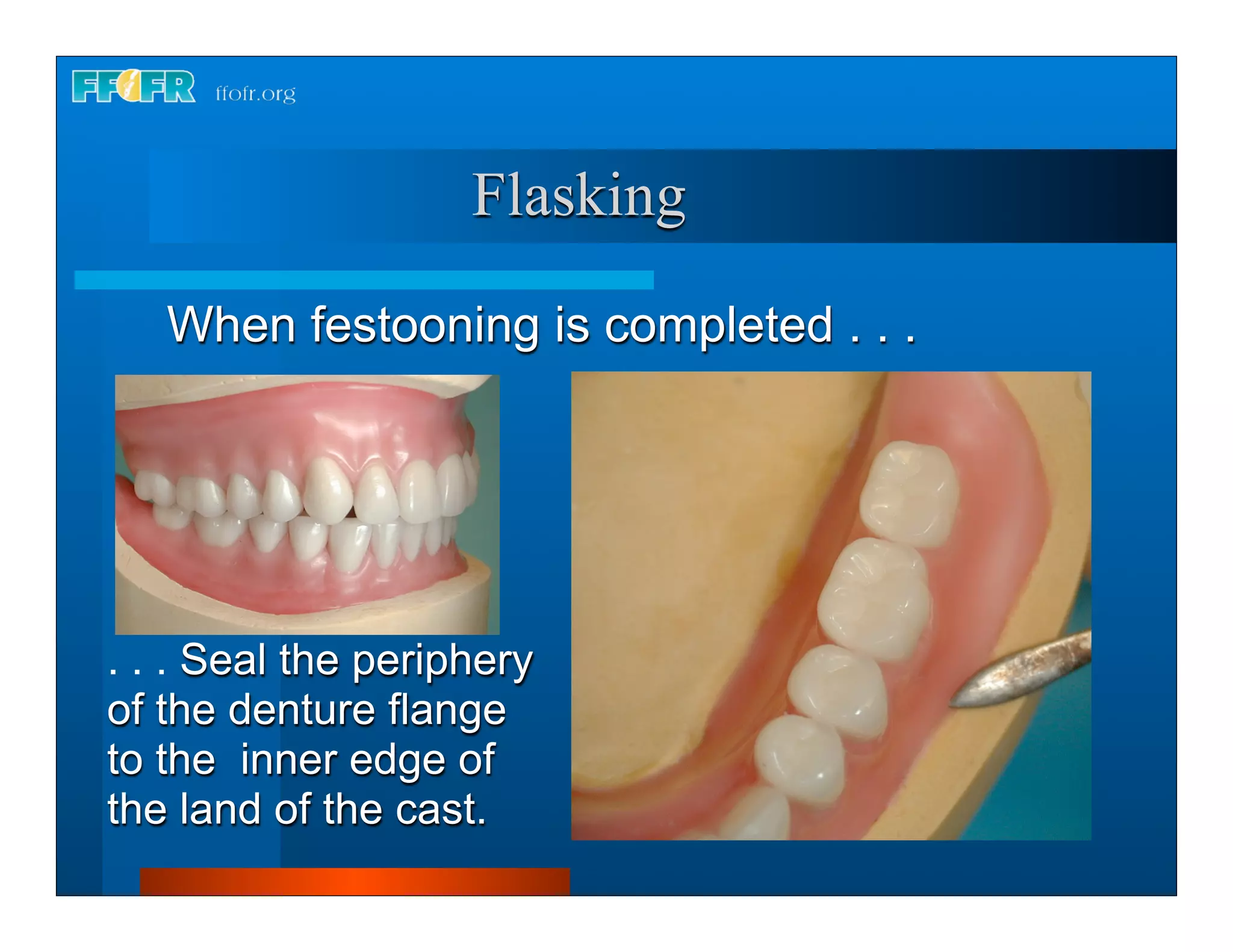 27.denture processing | PDF