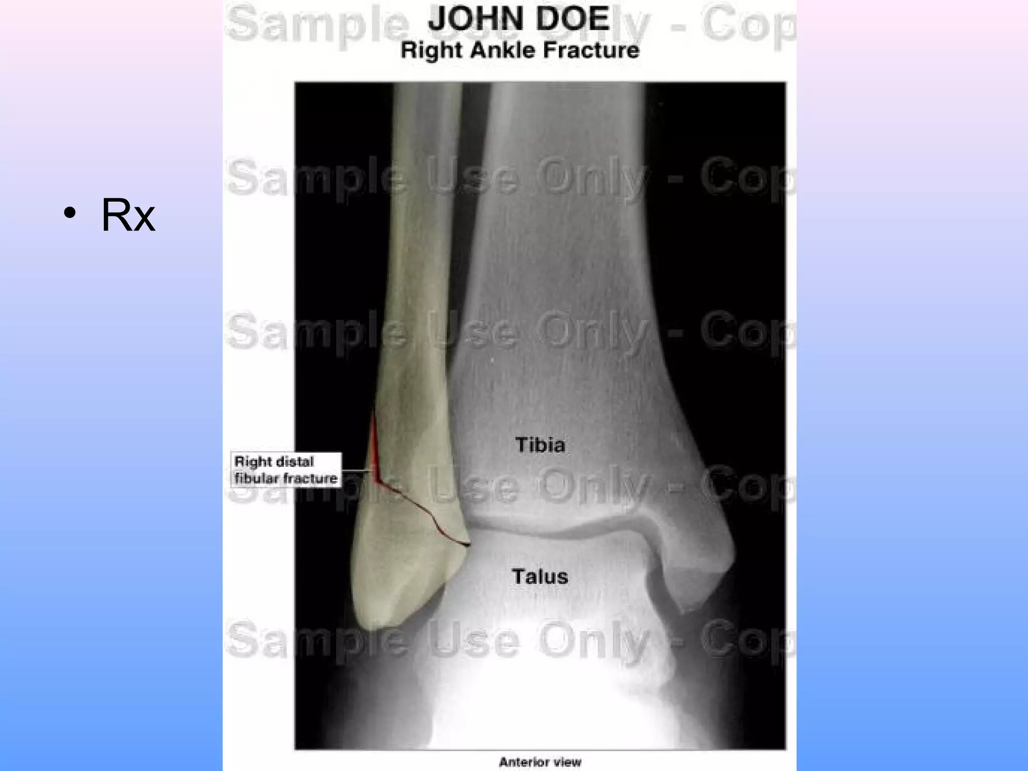 27. fracturas maleolares