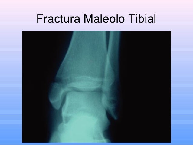 27. fracturas maleolares