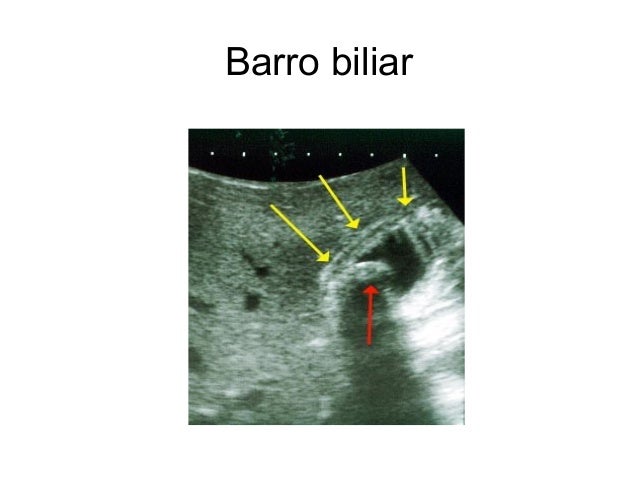 Patología biliar litiasica y no litiasica