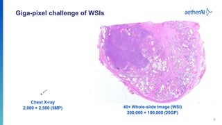 【aetherAI】AI-Assisted Diagnosis of Lymph Node Metastasis using GigaPixel AI technology | PPT