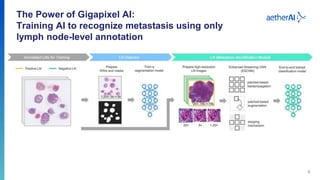【aetherAI】AI-Assisted Diagnosis of Lymph Node Metastasis using GigaPixel AI technology | PPTX