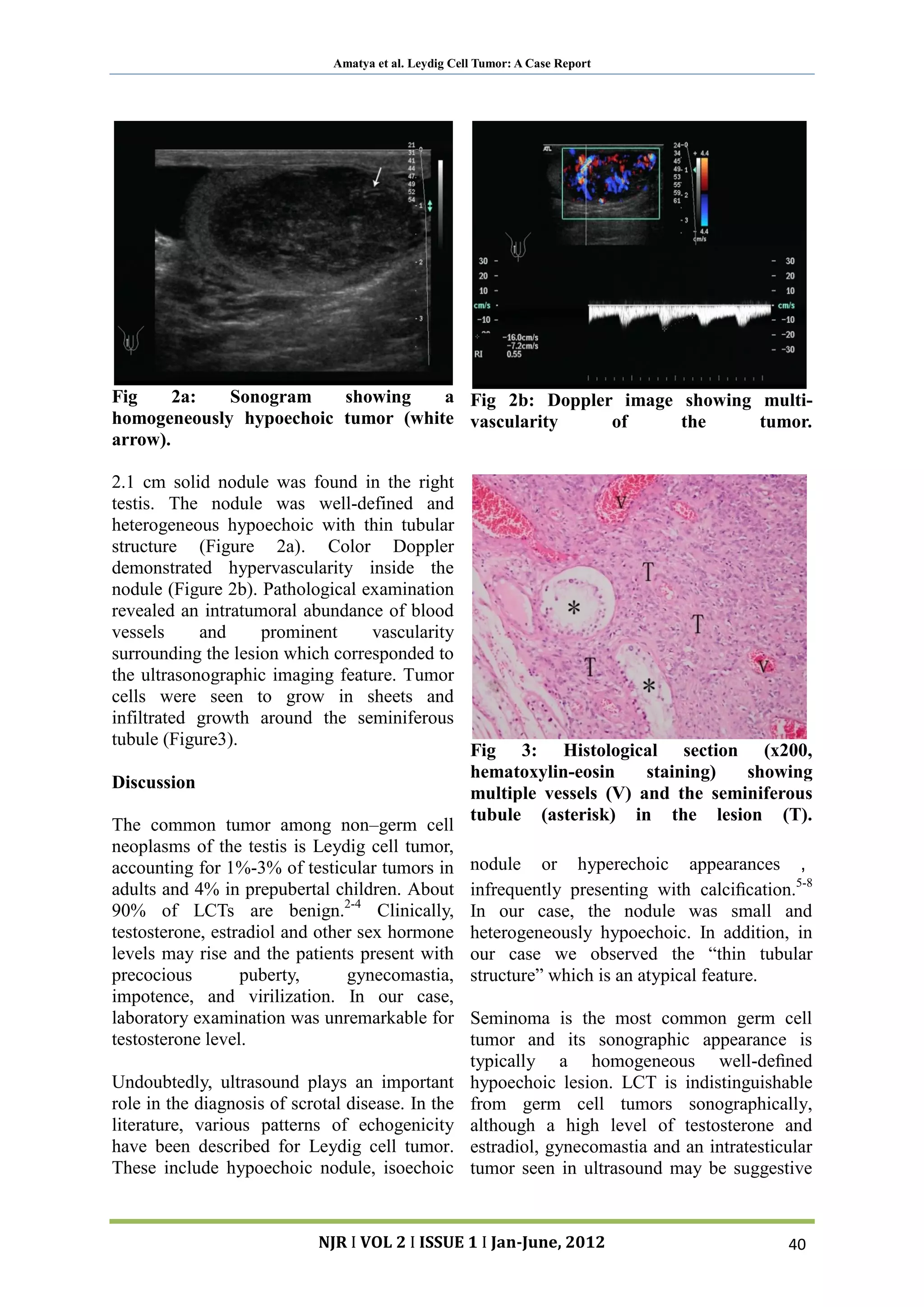 Leydig Cell Tumor A Case Report | PDF