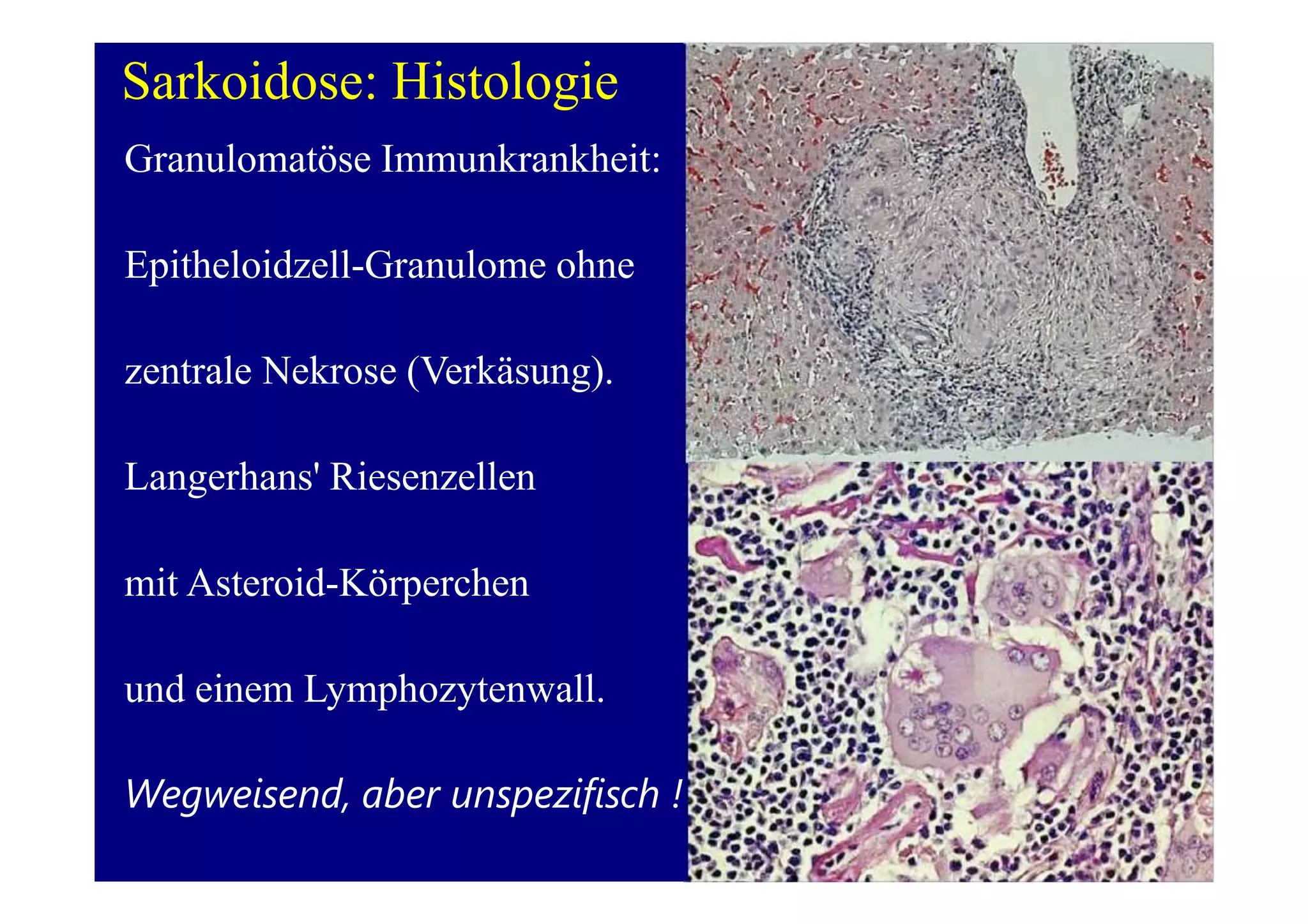 Die Sarkoidose, Teil 3. Labor, Röntgen und Histologie der Sarkoidose.…