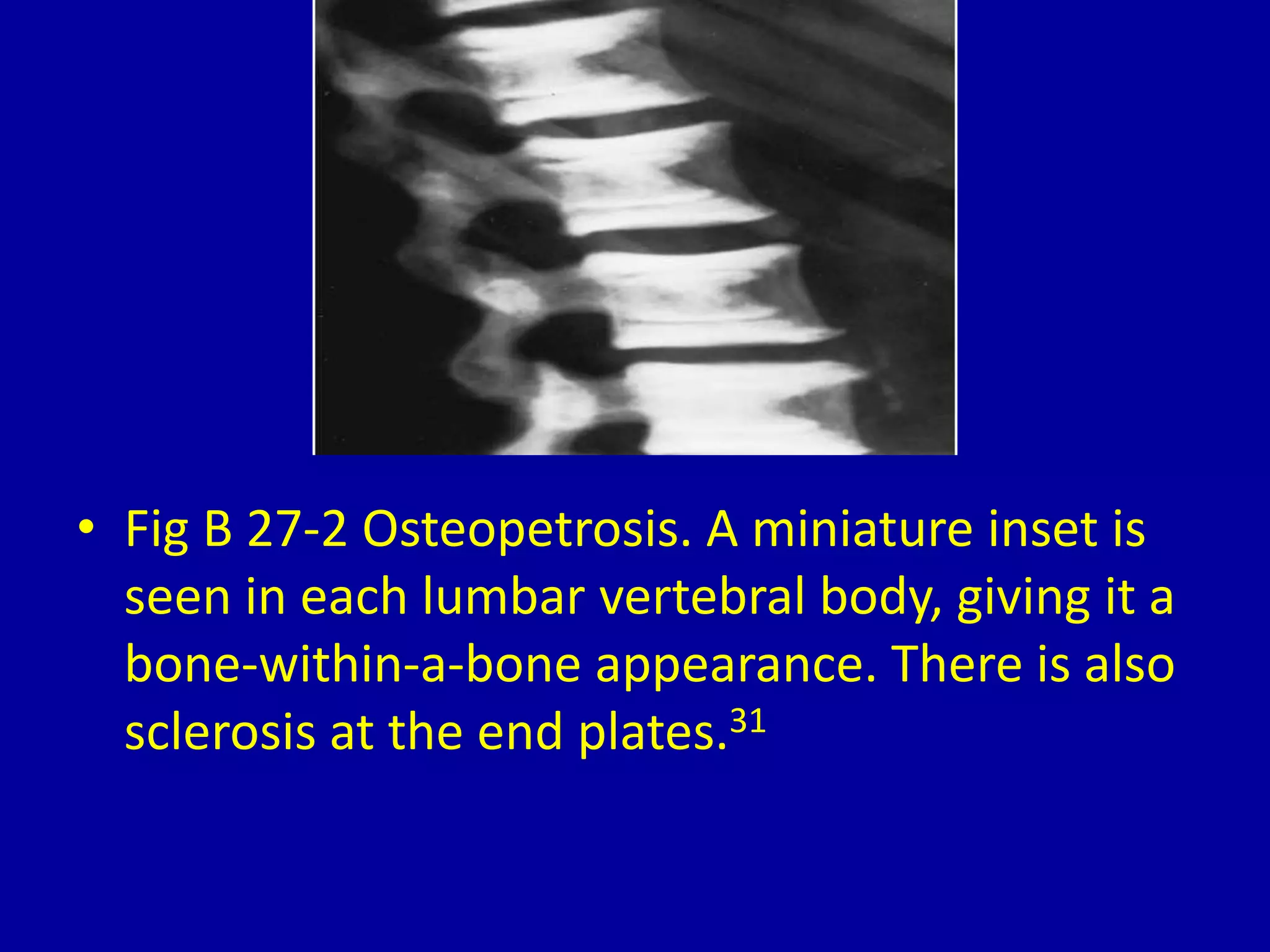 27 bone within-a-bone appearance | PPTX