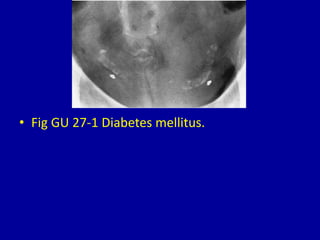 27 calcification of the vas deferens | PPTX