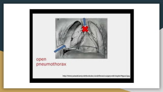 Open pneumothorax | PPTX