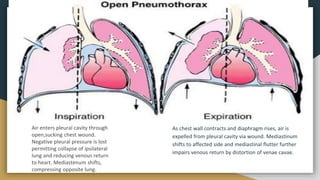 Open pneumothorax | PPT