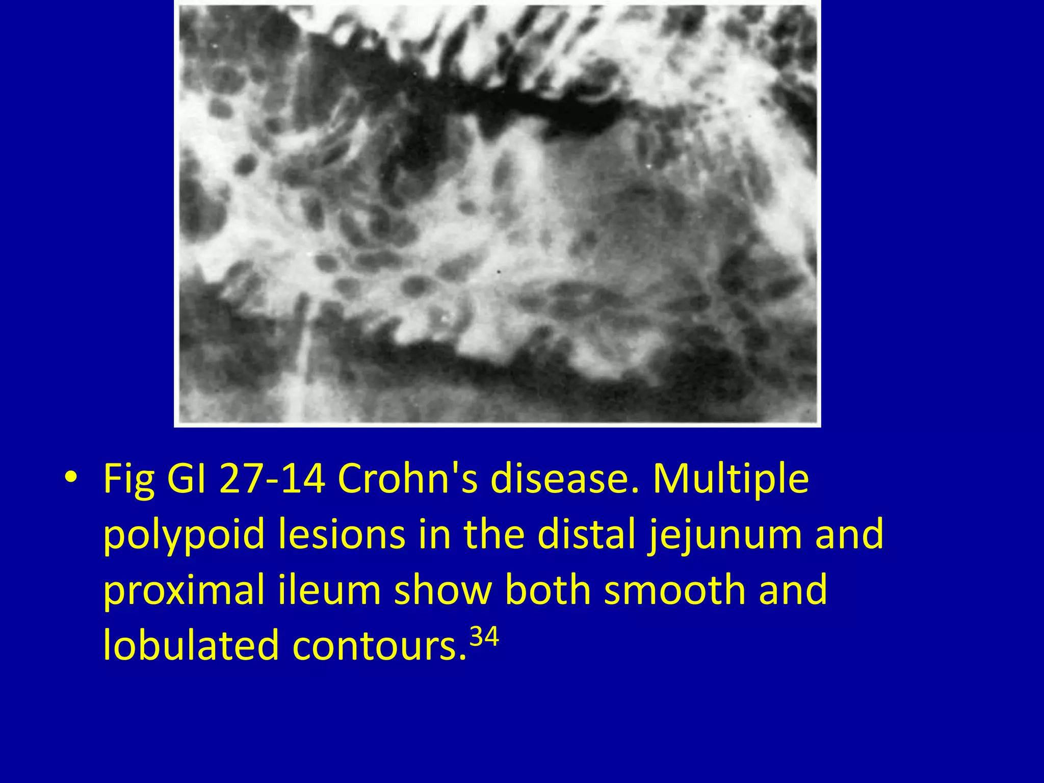 27 filling defects in the jejunum and ileum | PPT