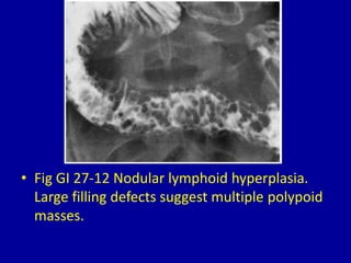 27 filling defects in the jejunum and ileum | PPT