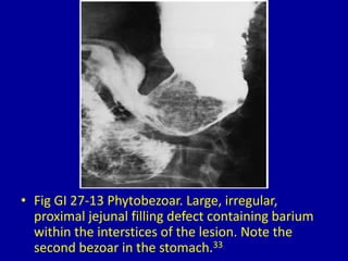 27 filling defects in the jejunum and ileum | PPTX