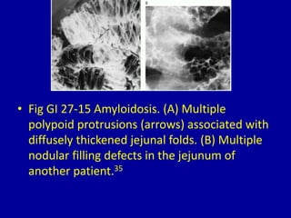 27 filling defects in the jejunum and ileum | PPT