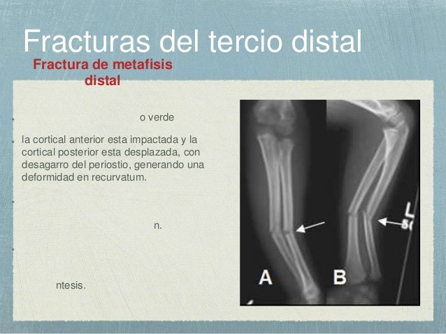 27 fractura de tibia y peroné