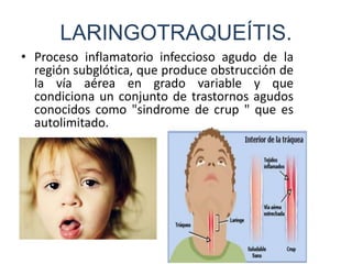 27 laringotraqueítis rgr | PPTX