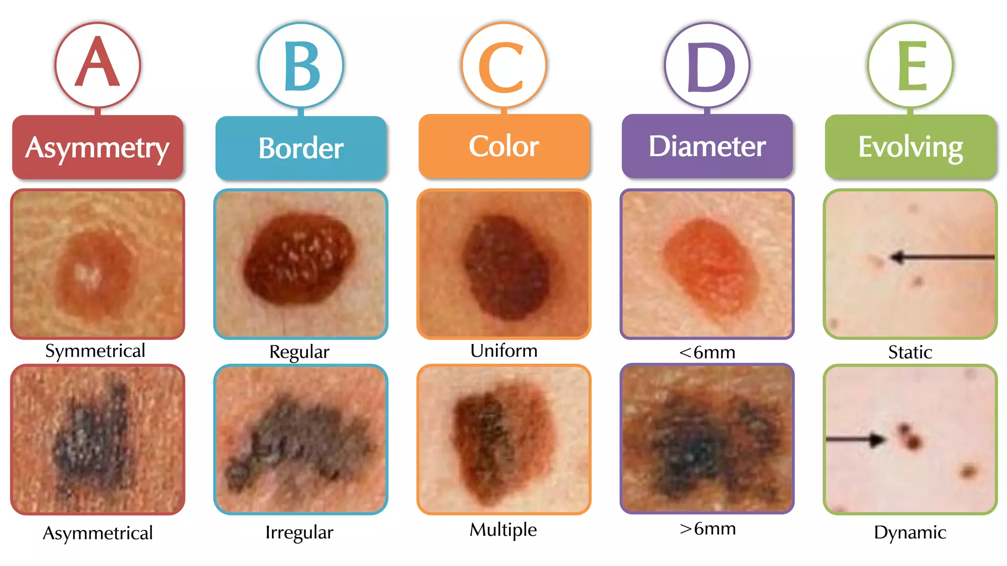 Melanoma | PPT