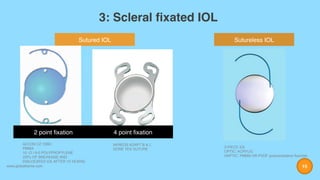 IOL options in the absence of capsular support | PDF | Eye and Vision ...