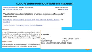 IOL options in the absence of capsular support | PDF | Eye and Vision ...