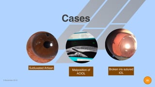IOL options in the absence of capsular support | PDF | Eye and Vision ...