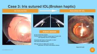 IOL options in the absence of capsular support | PDF | Eye and Vision ...