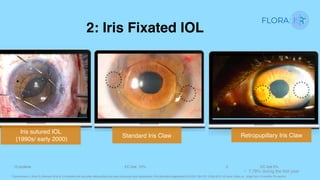 IOL options in the absence of capsular support | PDF | Eye and Vision ...