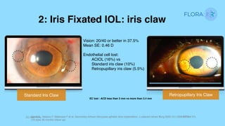 IOL options in the absence of capsular support | PDF | Eye and Vision ...