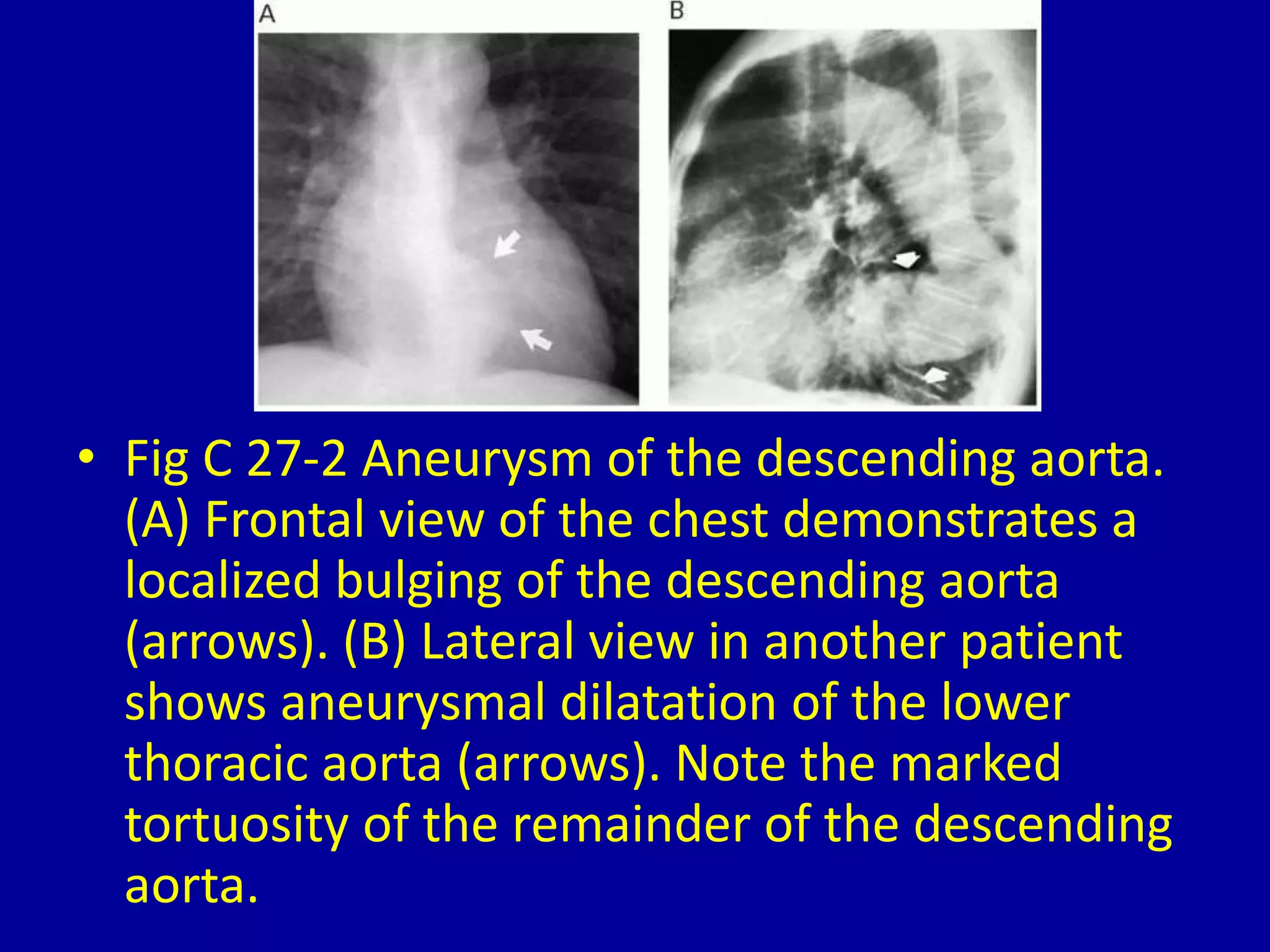 27 posterior mediastinal lesions | PPT