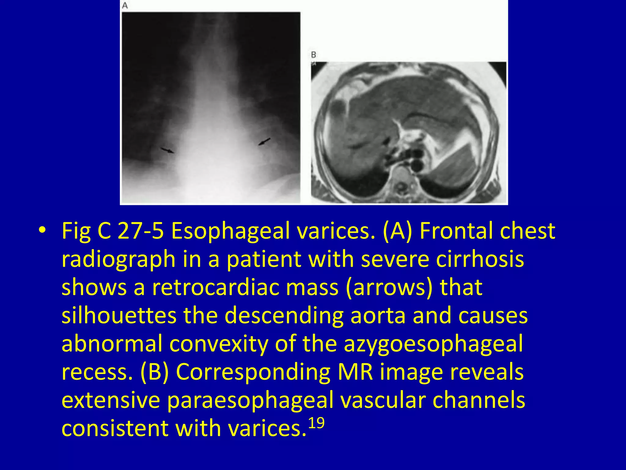 27 posterior mediastinal lesions | PPT