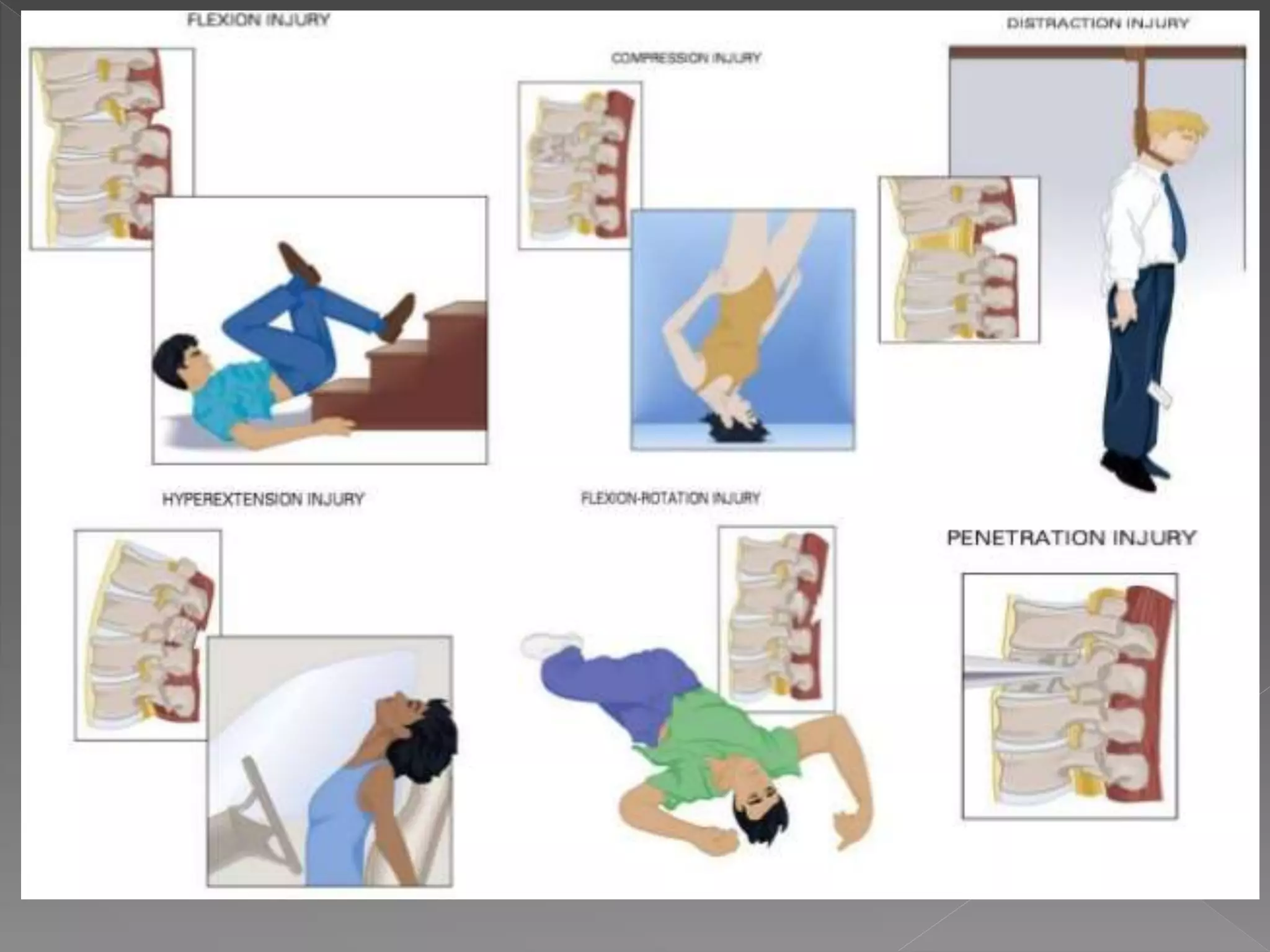 SPINAL CORD INJURY | PPTX | Death, Injury, or Military Conflict ...