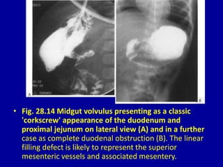 28 DAVID SUTTON PICTURES THE PEDIATRIC ABDOMEN | PPTX