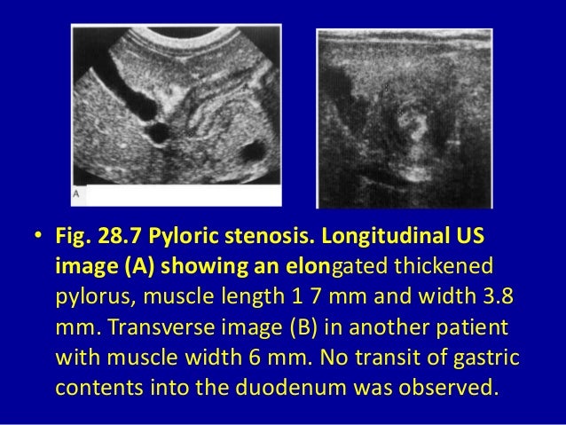 28 DAVID SUTTON PICTURES THE PEDIATRIC ABDOMEN