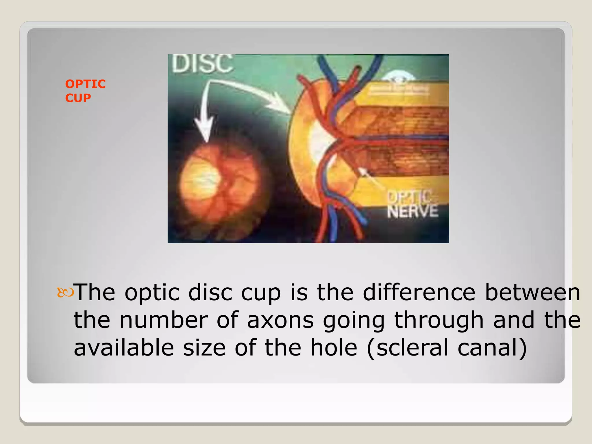 28. ONH evaluation in glaucoma | PPTX