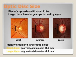 28. ONH evaluation in glaucoma | PPTX