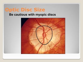 28. ONH evaluation in glaucoma | PPTX