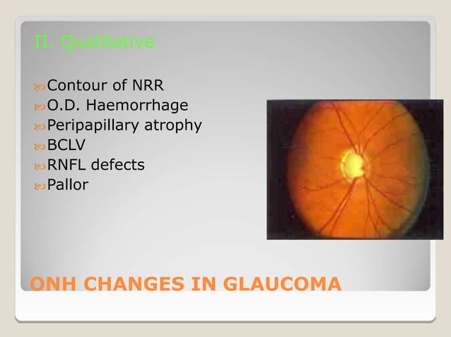 28. ONH evaluation in glaucoma | PPTX