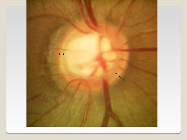 28. ONH evaluation in glaucoma | PPTX