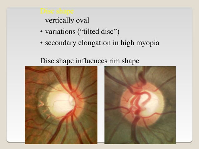 28. ONH evaluation in glaucoma | PPTX