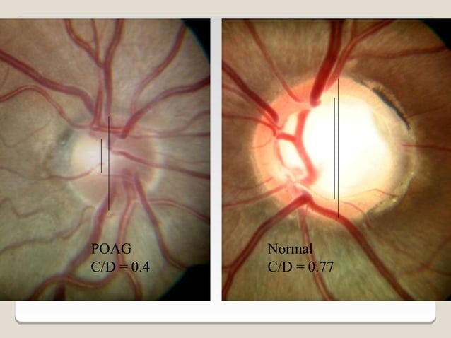 28. ONH evaluation in glaucoma | PPTX