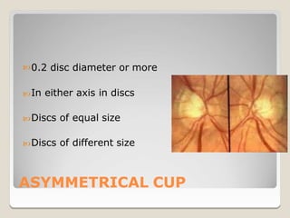 28. ONH evaluation in glaucoma | PPTX