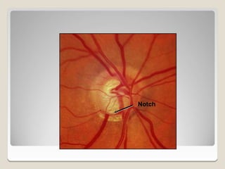 28. ONH evaluation in glaucoma | PPTX