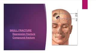 HEAD INJURY | PPTX