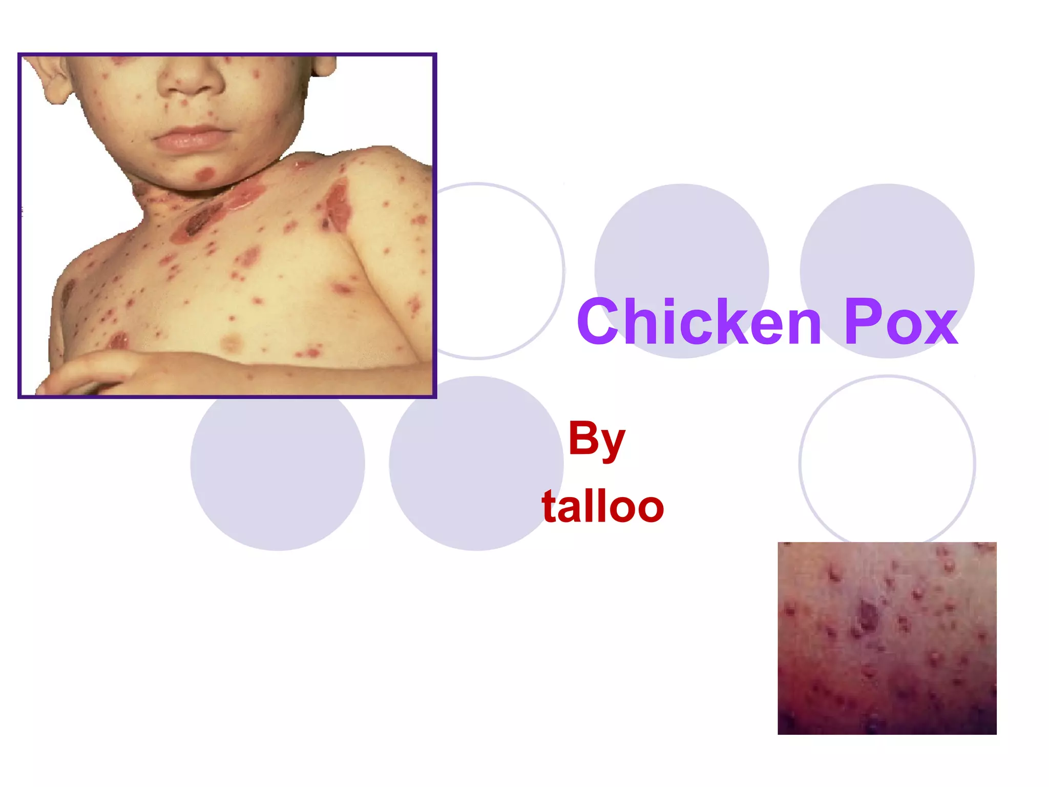 chicken pox | PPT | Infectious Diseases | Diseases and Conditions
