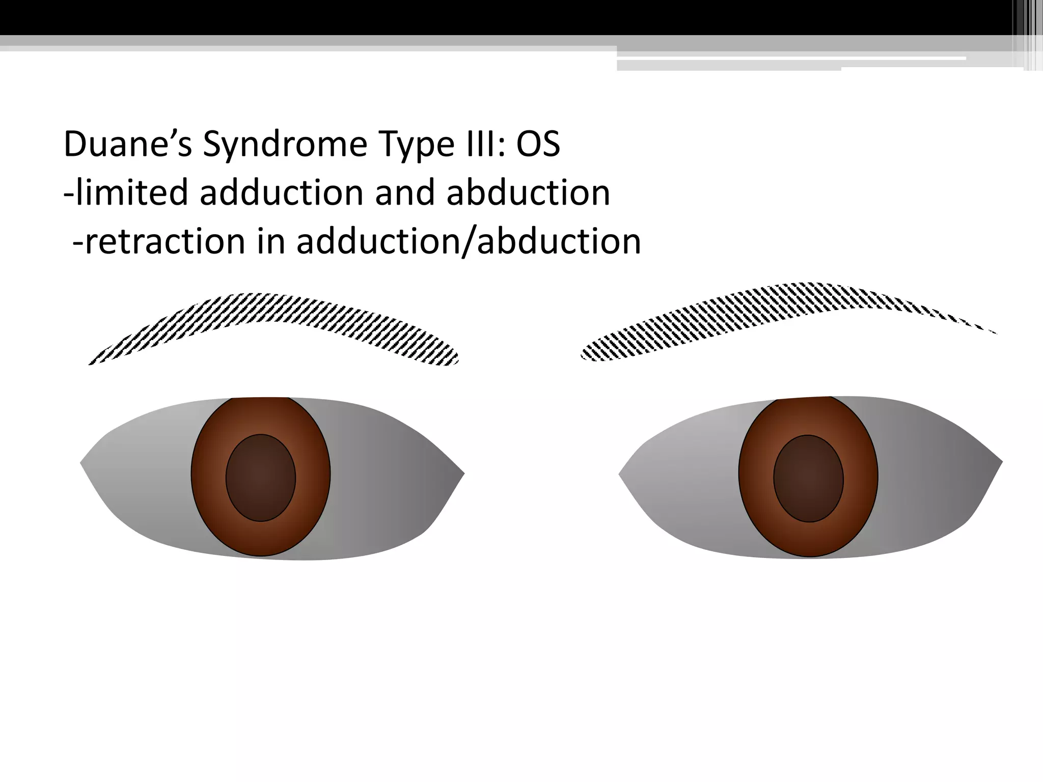 Duane Retraction Syndrome | PPT