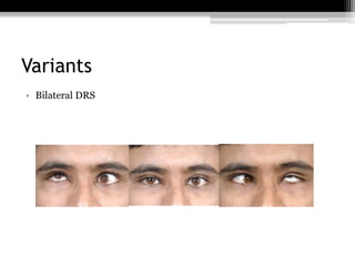 Duane Retraction Syndrome | PPT