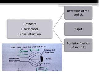 Duane Retraction Syndrome | PPT