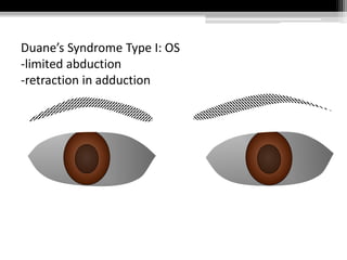 Duane Retraction Syndrome | PPT