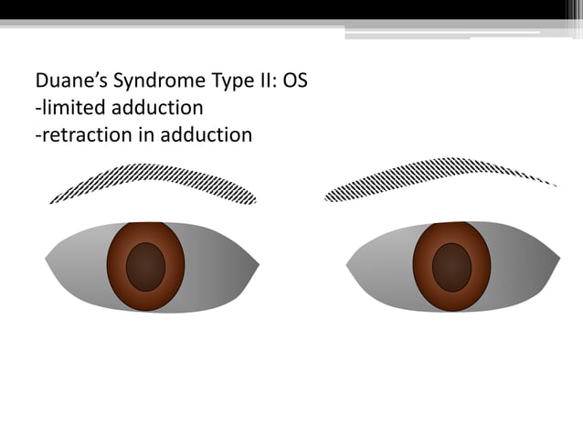 Duane Retraction Syndrome | PPT