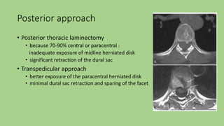 283 treatment of thoracic disk herniation | PPT