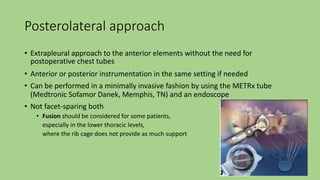 283 treatment of thoracic disk herniation | PPT