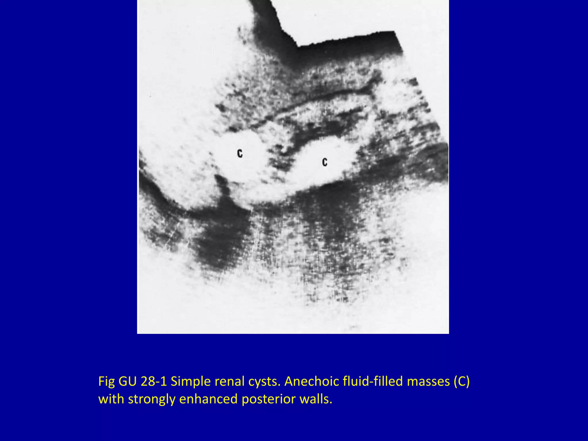 28 anechoic (cystic) renal masses | PPTX