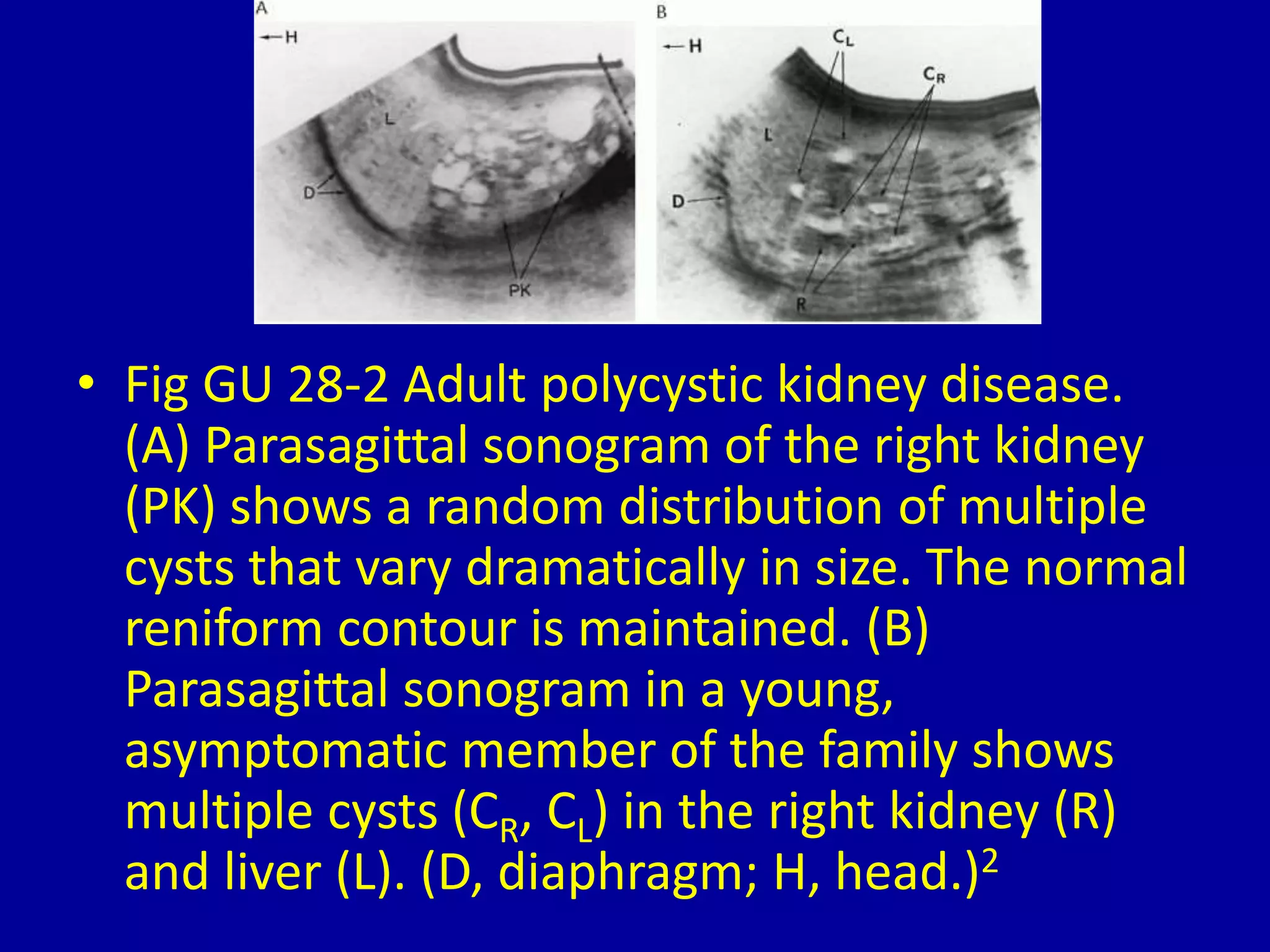 28 anechoic (cystic) renal masses | PPTX